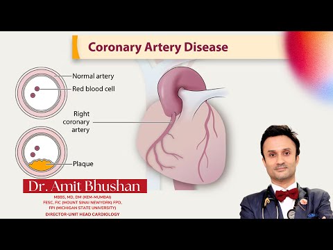 Coronary Artery Disease: Causes | Dr. Amit Bhushan Sharma | Cardiologist | Paras Hospital Gurgaon