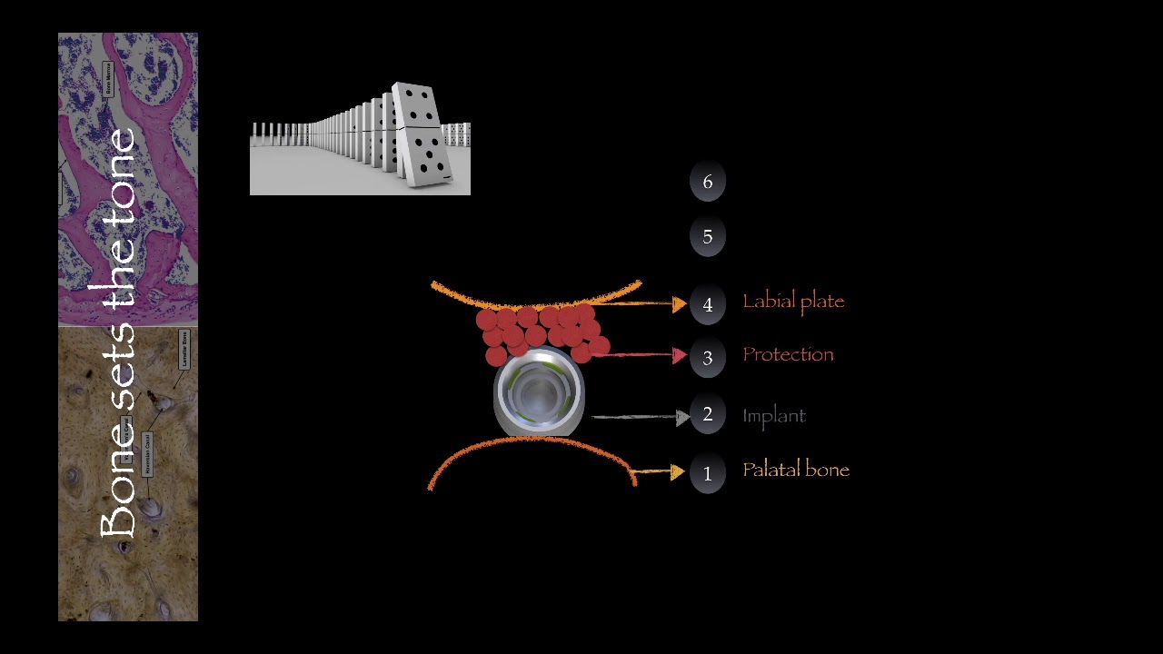Guided Bone Regeneration in Implant Dentistry:Tips and Hints part 2 by Dr Hassan Maghaireh- Leeds,UK