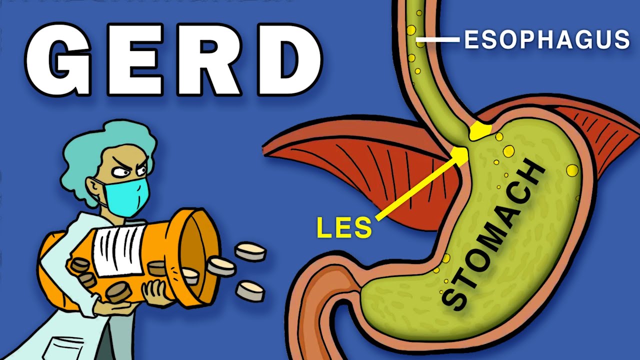 Gastroesophageal Reflux Disease (GERD)