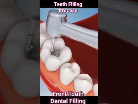 Tooth Filling Procedure Animation Teeth Filling Process