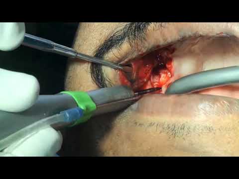 Part 1 - unblind pterygoid approach - DR.C.Murugavel for precise pterygoid implant surgery