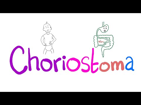Choristoma (Not a Hamartoma, and Not a True Neoplasia) | Pathology Series