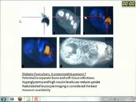 PET Scan in Orthopaedics