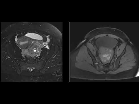 Ruptured Ectopic Pregnancy