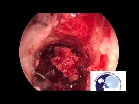 Nasocutaneous fistula complication posterior table fracture