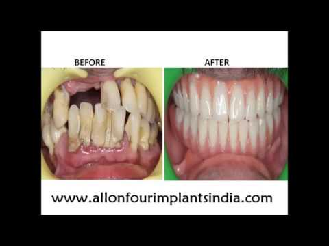 Big Billion Smiles # Best Laser Dental Clinic - Mugalivakkam