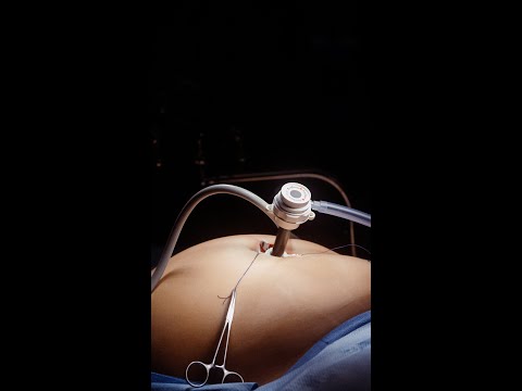 How to estimate length of bowel using retractors in laparoscopic gastric bypass #shorts
