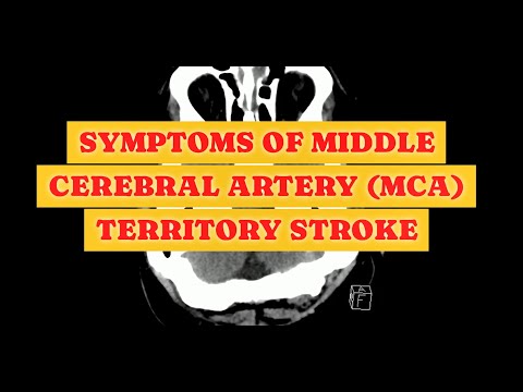 Symptoms of MCA Stroke