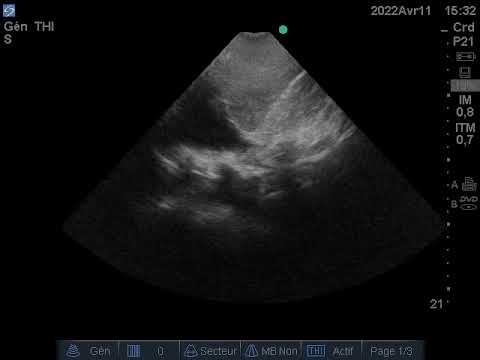 Épanchement pleural droit Rein Droit hyperéchogene et micro poly kystique Échographie
