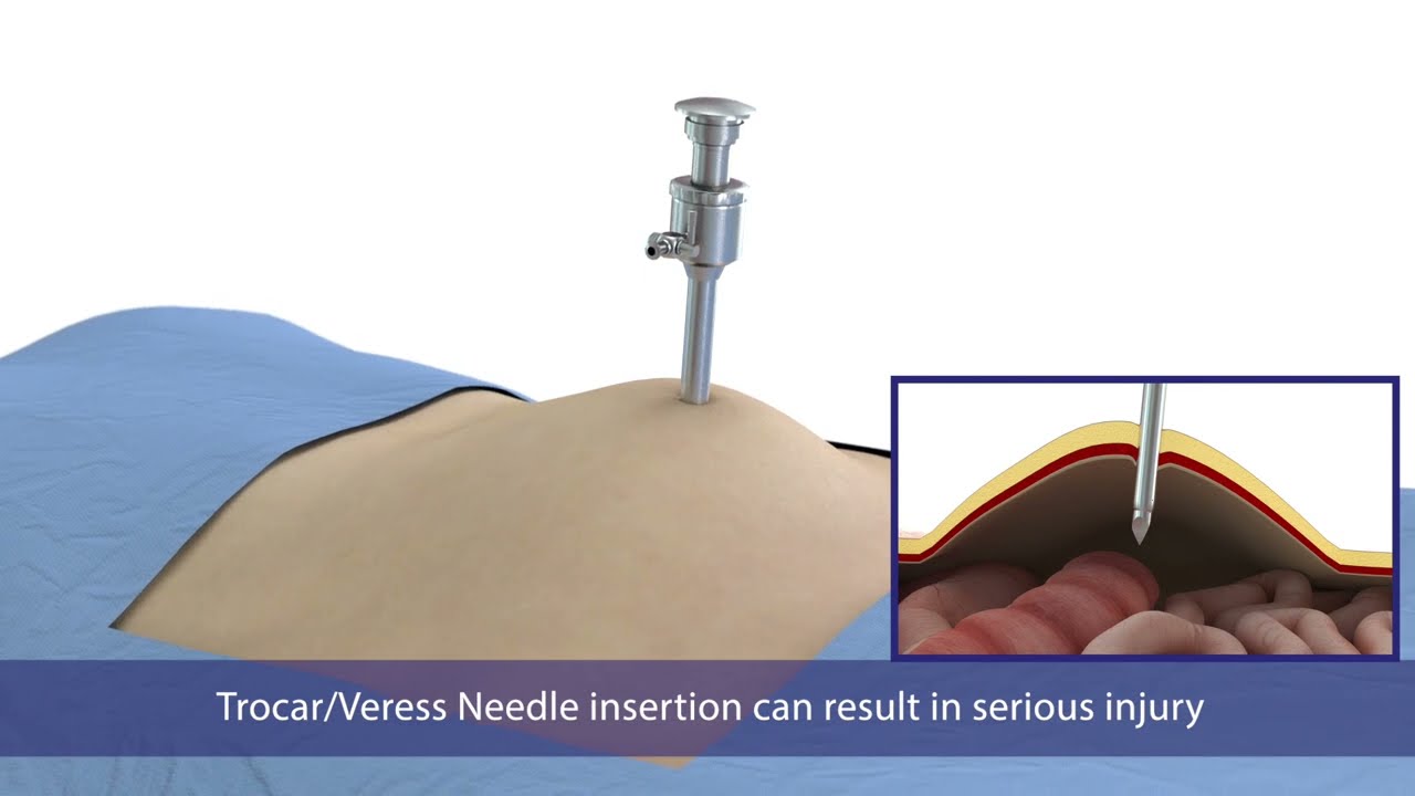 Introduction to Laparoscopy Surgery