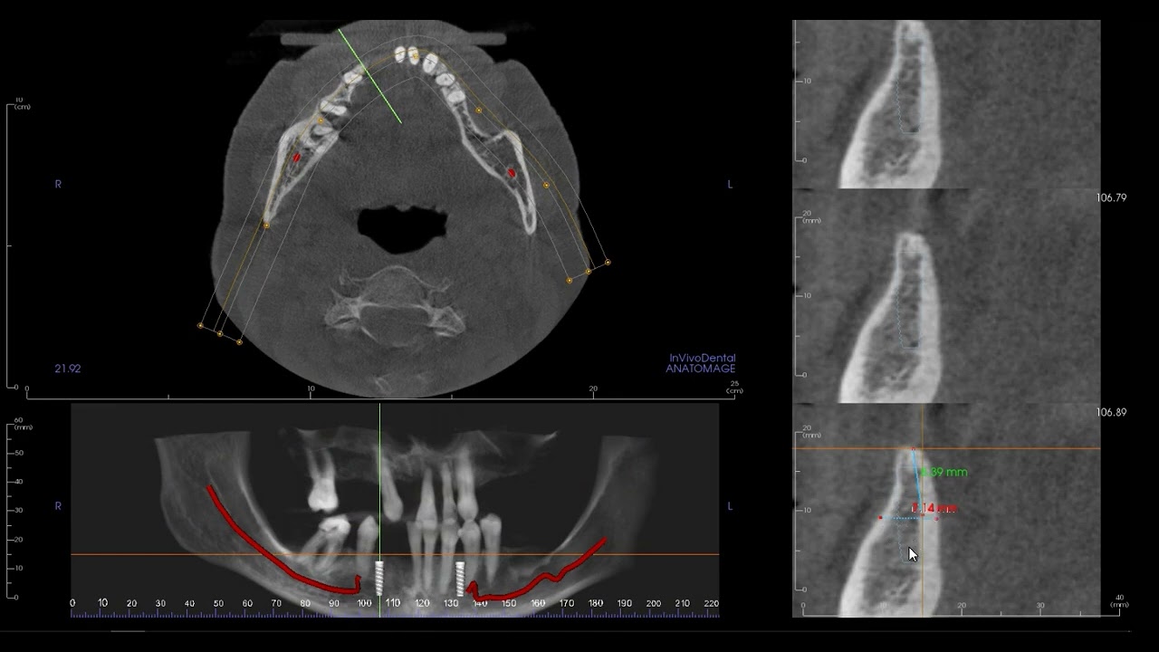 Mandibular Overdenture Treatment Planning Session #7