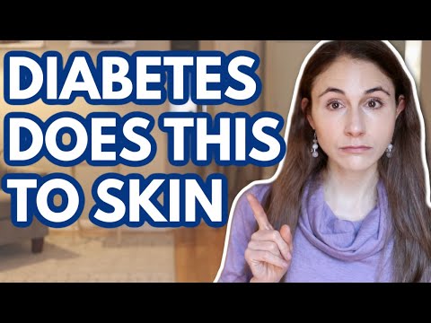 WHAT DIABETES DOES TO YOUR SKIN // DERMATOLOGIST @DrDrayzday