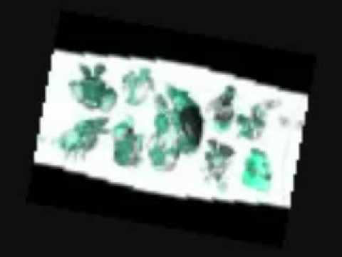 mmpu2 is seizurific