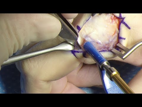 MP Joint Collateral Ligament Reconstruction Augmented with an Internal Brace