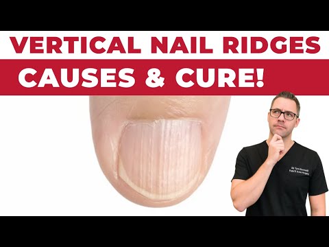 🖐Do you have Vertical Nail Ridges? [Causes & Treatment]🖐