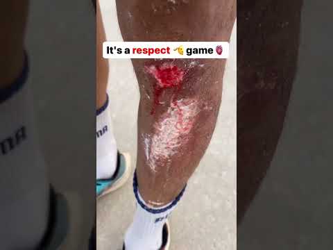 Skating Race Accident ???? #skate #skating #youtube #youtubeshorts #shortsvideo #sport #india