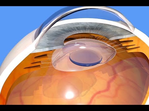 Hindi/Urdu Cataracts, Cataract Surgery and Aftercare, by Dr Rahila Zakir FRCOphth, London, UK.