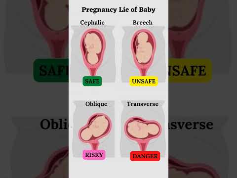 Presentation and Baby's Lie During Pregnancy ????#shorts