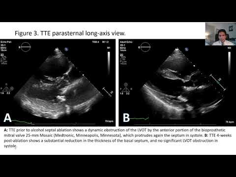 Engel Gonzolez _Preemptive Alcohol Septal Ablation_Structural