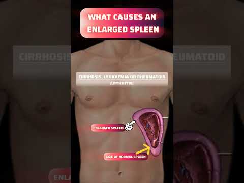 what causes an enlarged spleen - Splenomegaly #spleen