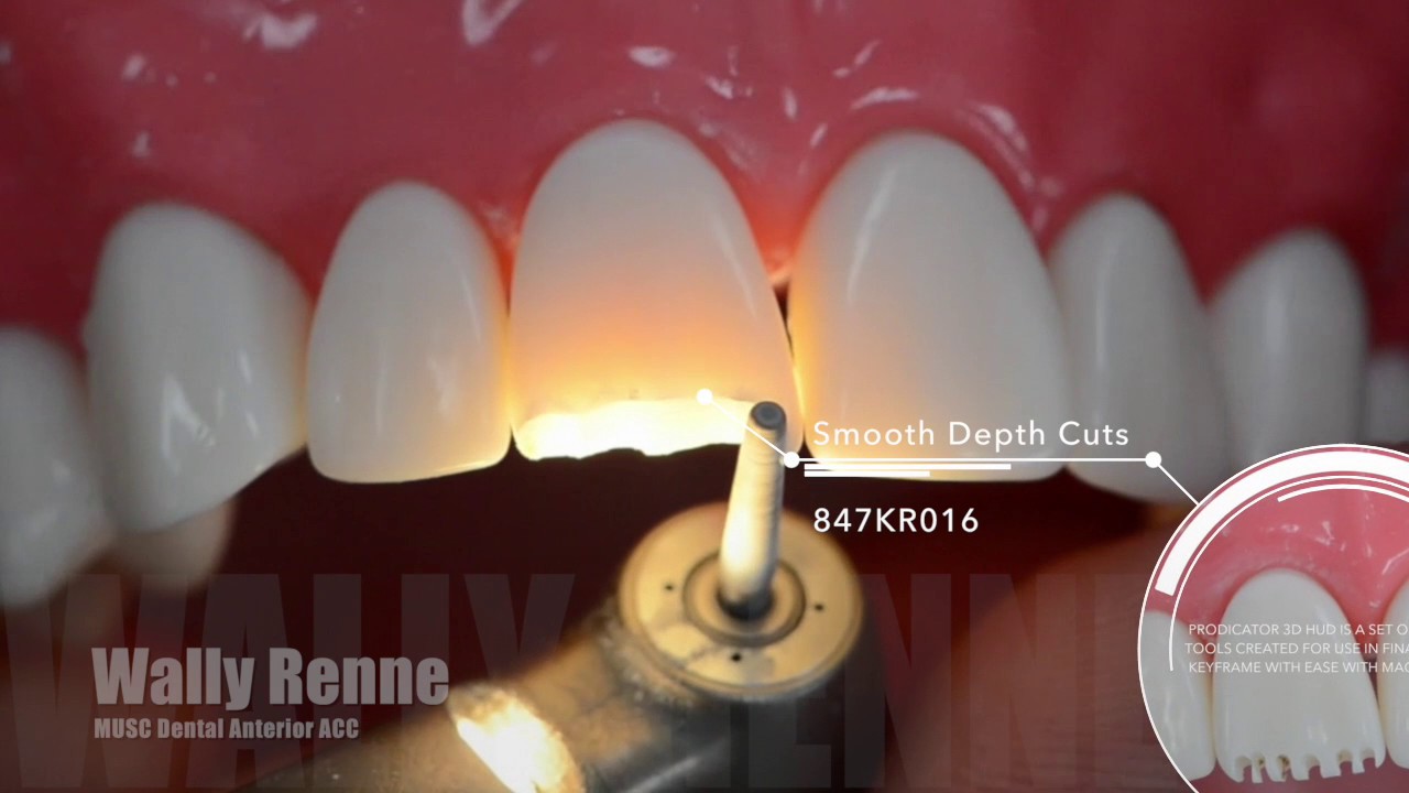 Anterior All Ceramic Crown Prep ACC For Dental Students