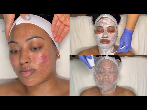 CYSTIC ACNE TREATMENT | WALK-IN FACIAL FOR GRADE 3 AND 4 ACNE WITH PRO TIPS | LICENSED ESTHETICIAN
