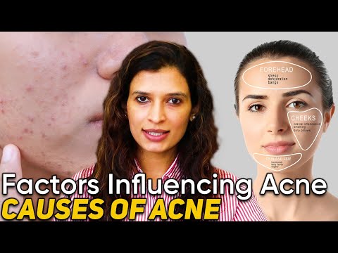 Factors Influencing Acne | Causes of Acne