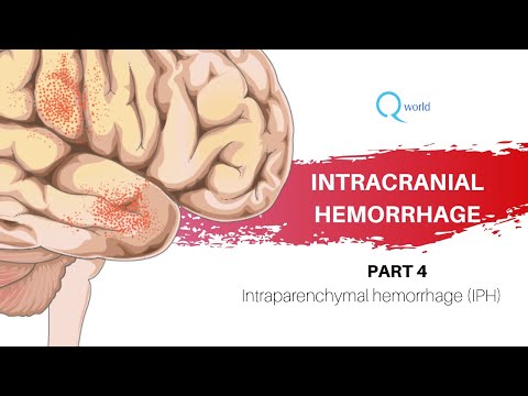 Intracranial hemorrhage Part 4 OF 4 : Intraparenchymal hemorrhage (IPH): USMLE and NEXT/NEET-PG