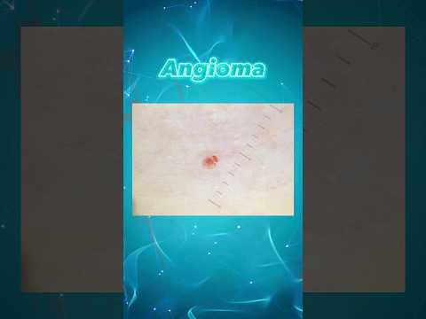 ANGIOMA | MEDICAL DEFINITION VOCABULARY TERMINOLOGY - Expand your work vocabulary
