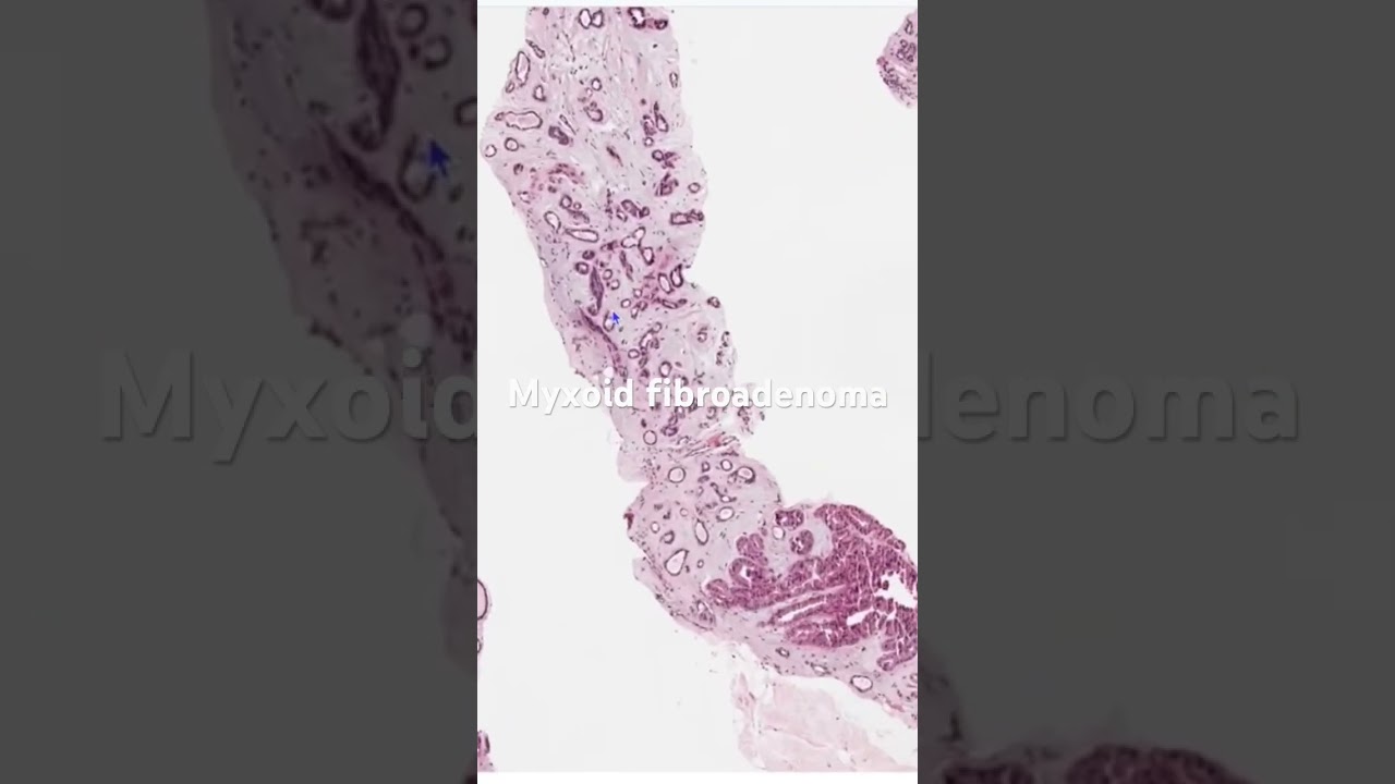 Myxoid fibroadenoma