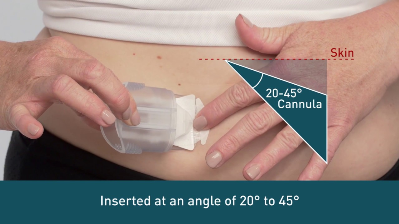 Infusion Sets for Beginners: What Are Infusion Sets?