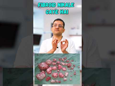 36 fibroids removed from a single lady | Non surgical treatment of fibroids | Dr. Gaurav Gangwani |