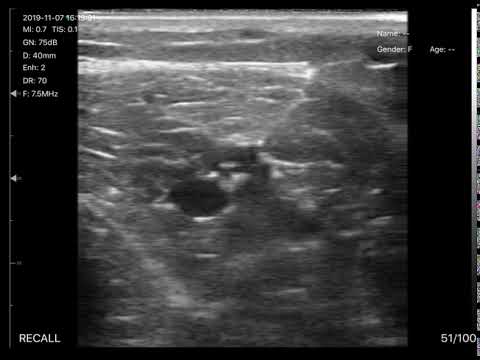 L5 | DVT Exam for Calf Veins | Portable Ultrasound Probe