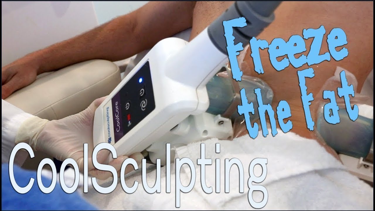 CoolSculpting to Freeze the Fat Away