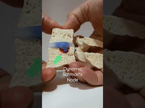 Dynamic Schmorl's Node