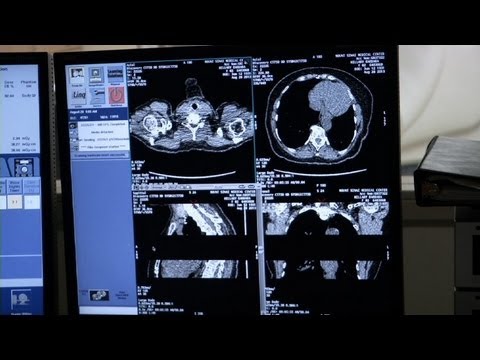 Can CT scans for smokers save lives?