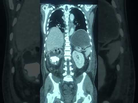 Abdomen CT with contrast, coronal plane