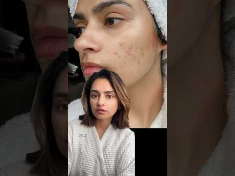 The Ultimate Dark Spots Treatment 🙌🏼