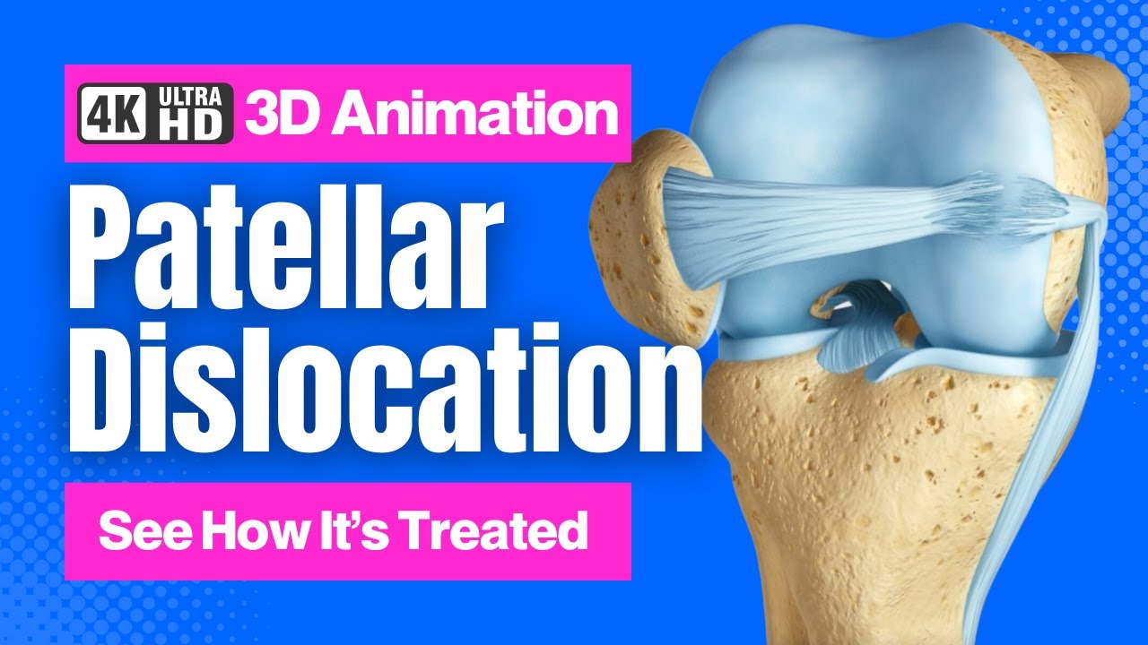 Patellar Dislocation Explained | MPFL Tear, MPFL Reconstruction, TTO, & Lateral Release 3D Animation