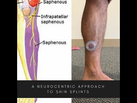 Shin Splints -- Common Reasons Why -- Uncommon Treatment Options