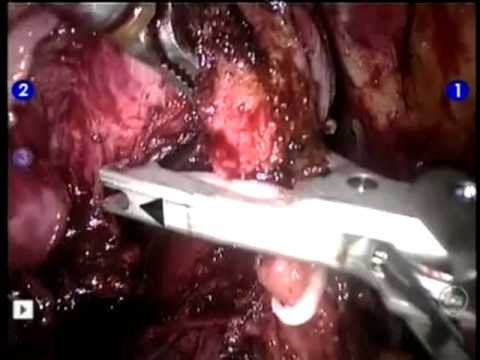 Prostaatkanker - Dissectie neuro vasculaire bundels