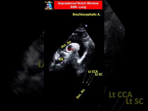 Suprasternal Notch Echo