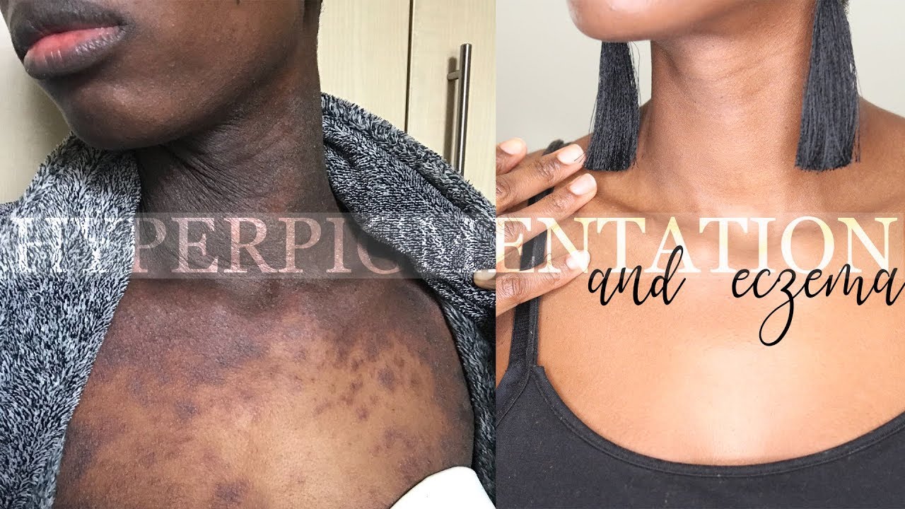 Healing Eczema and Hyperpigmentation: A Personal Journey and Q&A ...