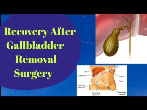 Care After Gallbladder Removal Surgery!Lifestyle After Laproscopic cholecystectomy Surgery!