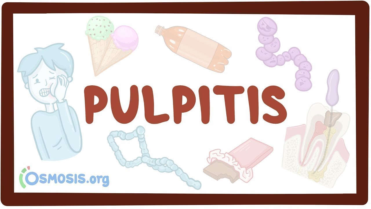 Pulpitis - causes, symptoms, diagnosis, treatment, pathology