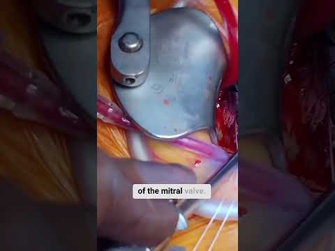 Aortic Valve Replacement With Mitral and Tricuspid Valve Repair Via a Right Anterior Thoracotomy