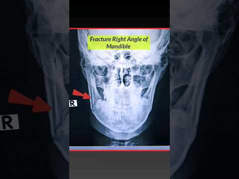 Mandible Fracture X-Ray #xray #fracture #radiographerusn