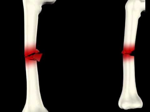 Bone Comminuted Fracture Treatment