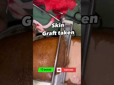 Can BIG ulcer wounds really heal? 🤔 SEE how skin grafting works wonders