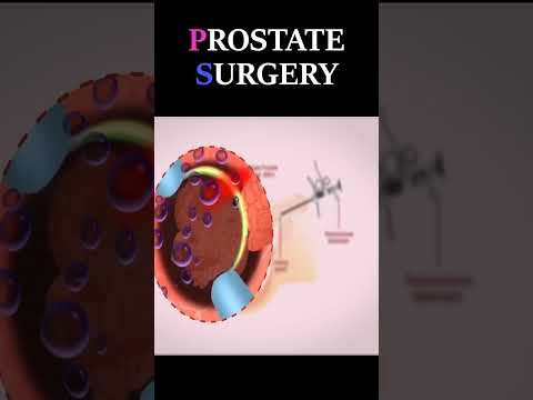 Transurethral Resection of the Prostate #shorts #prostate